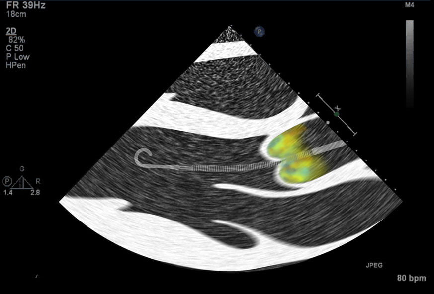 Impella Catheter Positioning - Dr. Zad