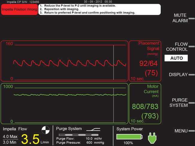 Impella CP Catheter Position Alarms - Dr. Zad