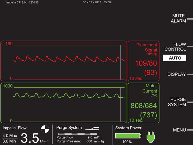 Impella CP Catheter Position Alarms - Dr. Zad