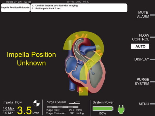 Impella CP Catheter Position Alarms - Dr. Zad