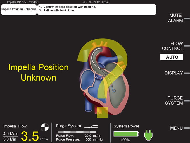 Impella CP Catheter Position Alarms - Dr. Zad