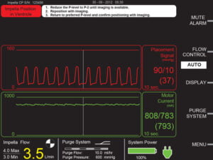 Impella CP Catheter Position Alarms - Dr. Zad